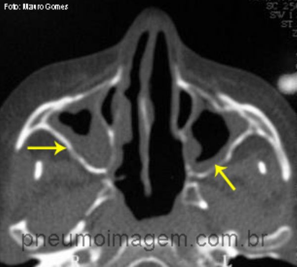 PNEUMOIMAGEM - vias-aereas-superioresPneumoImagem