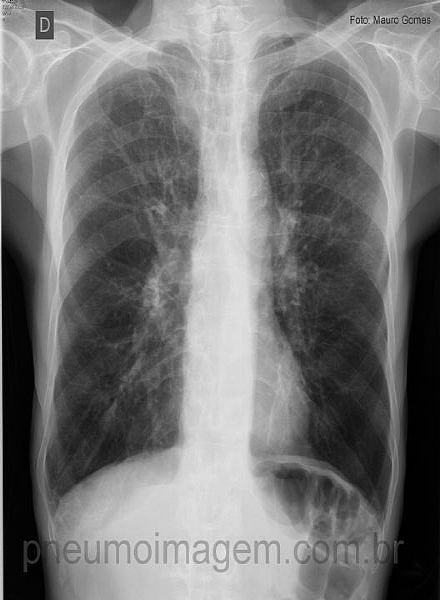 Pneumoimagem - Portal de imagens e notícias em Pneumologia