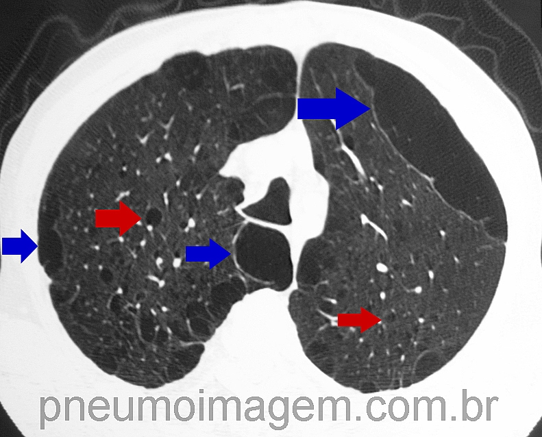 Pneumoimagem - Portal de imagens e notícias em Pneumologia