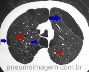 Pneumoimagem - Portal de imagens e notícias em Pneumologia