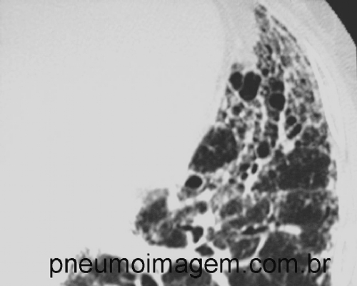 Pneumoimagem - Portal de imagens e notícias em Pneumologia